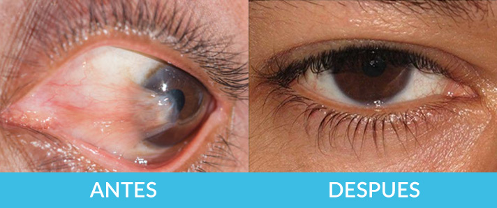 Pterygium Treatment NY2020